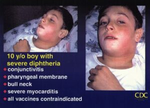 Diphtheria Photos | Vaccine Information