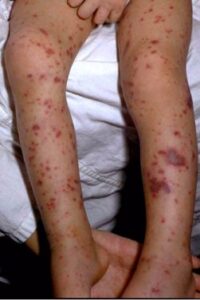 Meningococcal Photos | Vaccine Information