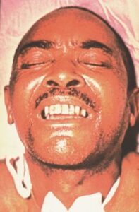 Tetanus Photos | Vaccine Information